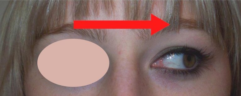 Doppelbilder, Schielen, Augenmuskeltraining, Therapiealternative zur ...