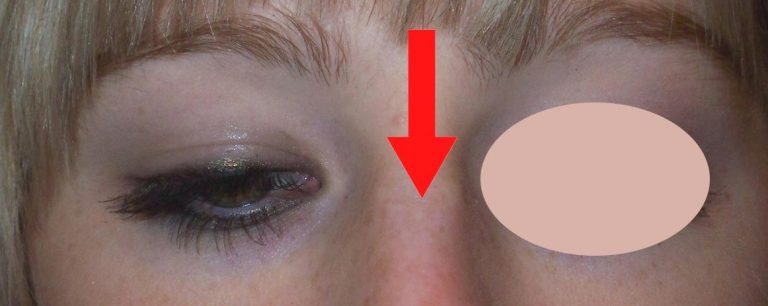 Doppelbilder, Schielen, Augenmuskeltraining, Therapiealternative zur ...